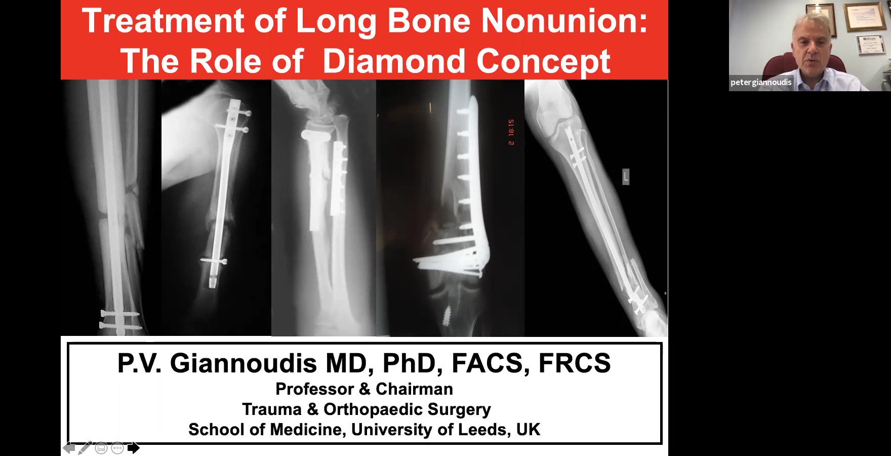 The Treatment of Long Bone Nonunion & the Role of Diamond Concept | Doc ...